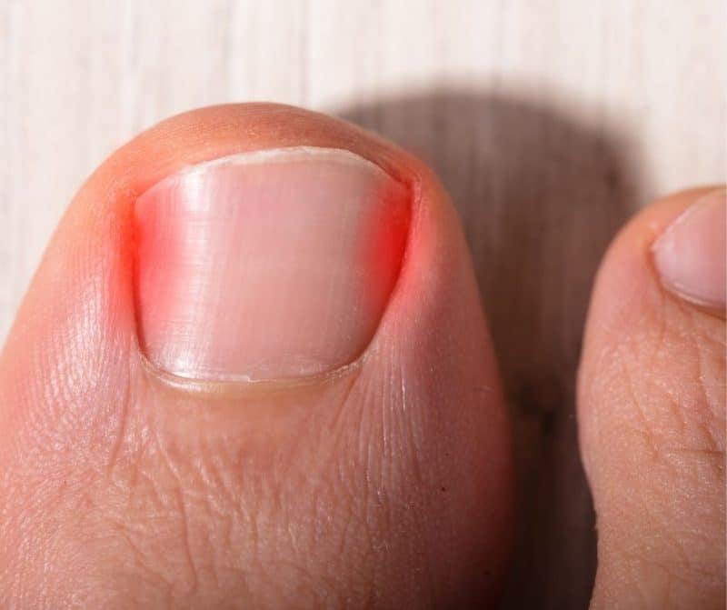Callus Removal At Home: 5 Top Tips - Northwich Foot Clinic