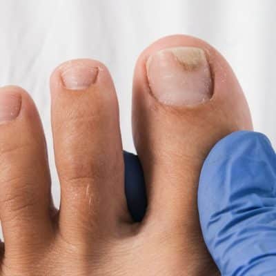 What To Expect After Nail Removal Surgery