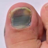 Nail Trauma: What To Do If Your Toenail Is Injured Or Falls Off